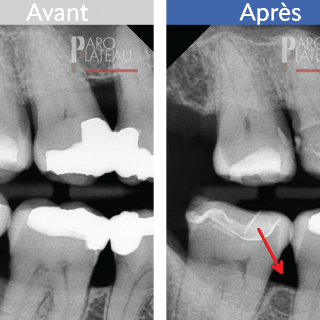 Paradontie à Montréal | Clinique de parodontie du Plateau